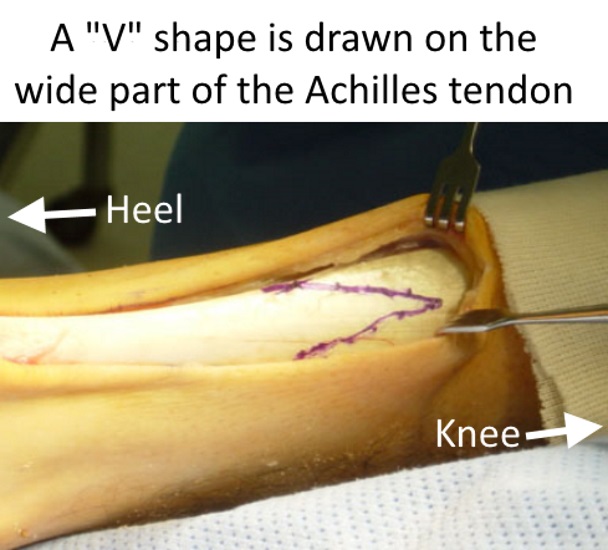 V Y Lengthening Drwolgin