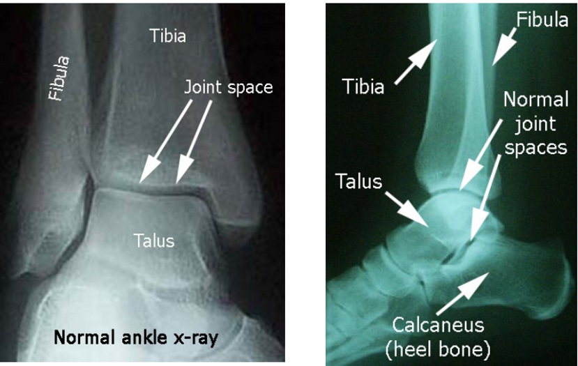 Ankle Arthritis Drwolgin Ankle Arthritis Drwolgin
