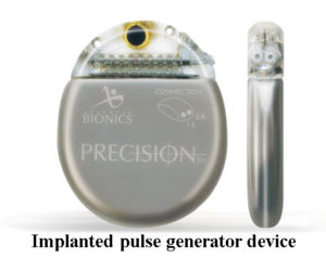 Spinal Cord Stimulator - Drwolgin
