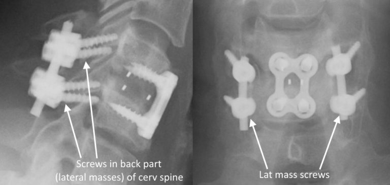 Anterior Cervical Discectomy and Fusion (ACDF) - Drwolgin