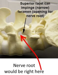 Foraminotomy - Drwolgin