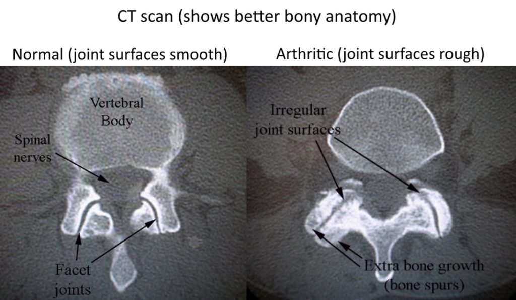 Facet Arthritis - Drwolgin