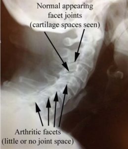 Facet Arthritis - Drwolgin