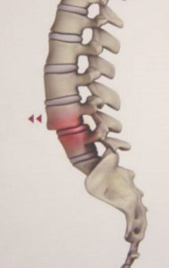 Spondylolisthesis - Drwolgin